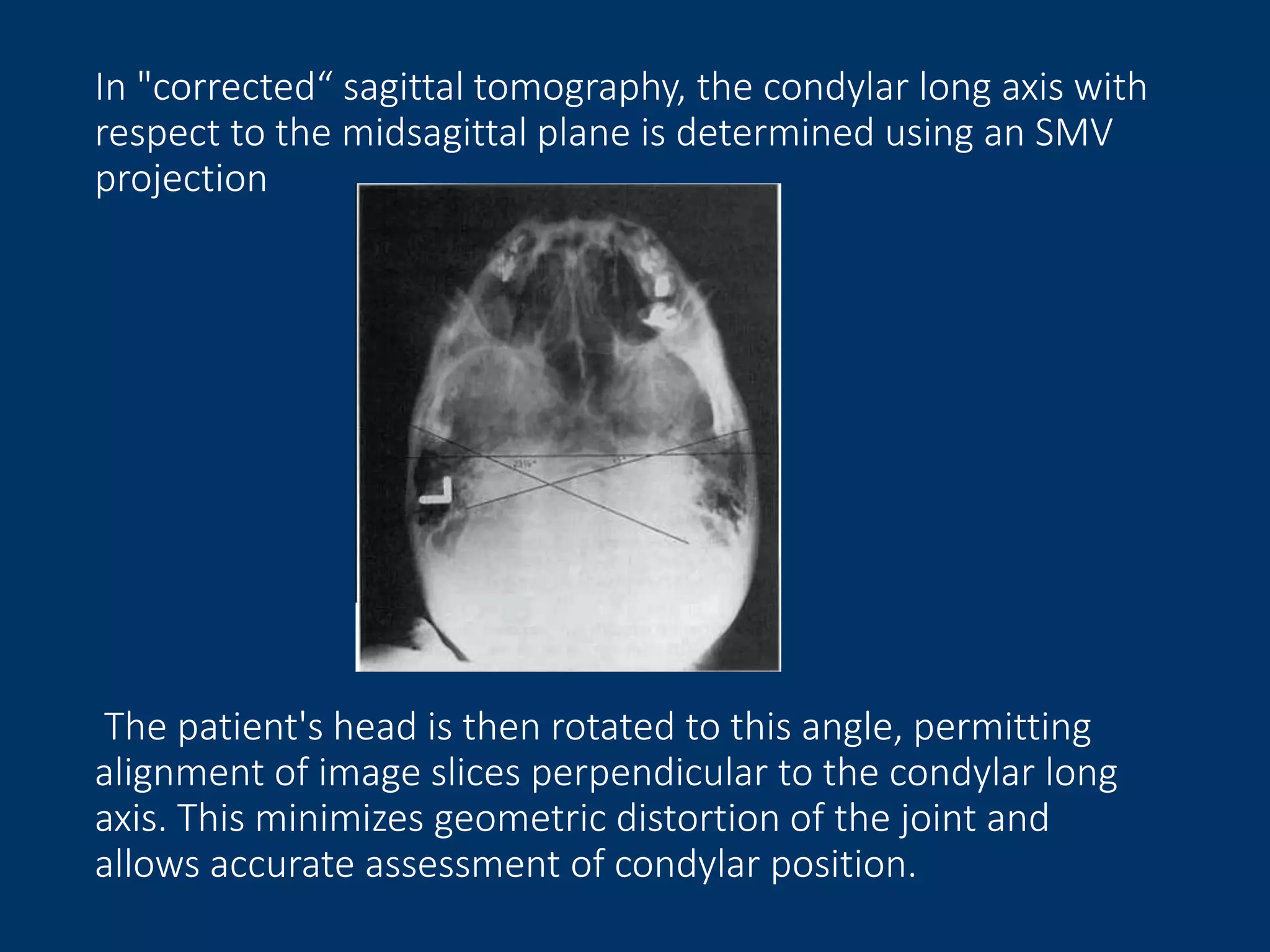 Temporomandibular joint imaging | PPTX