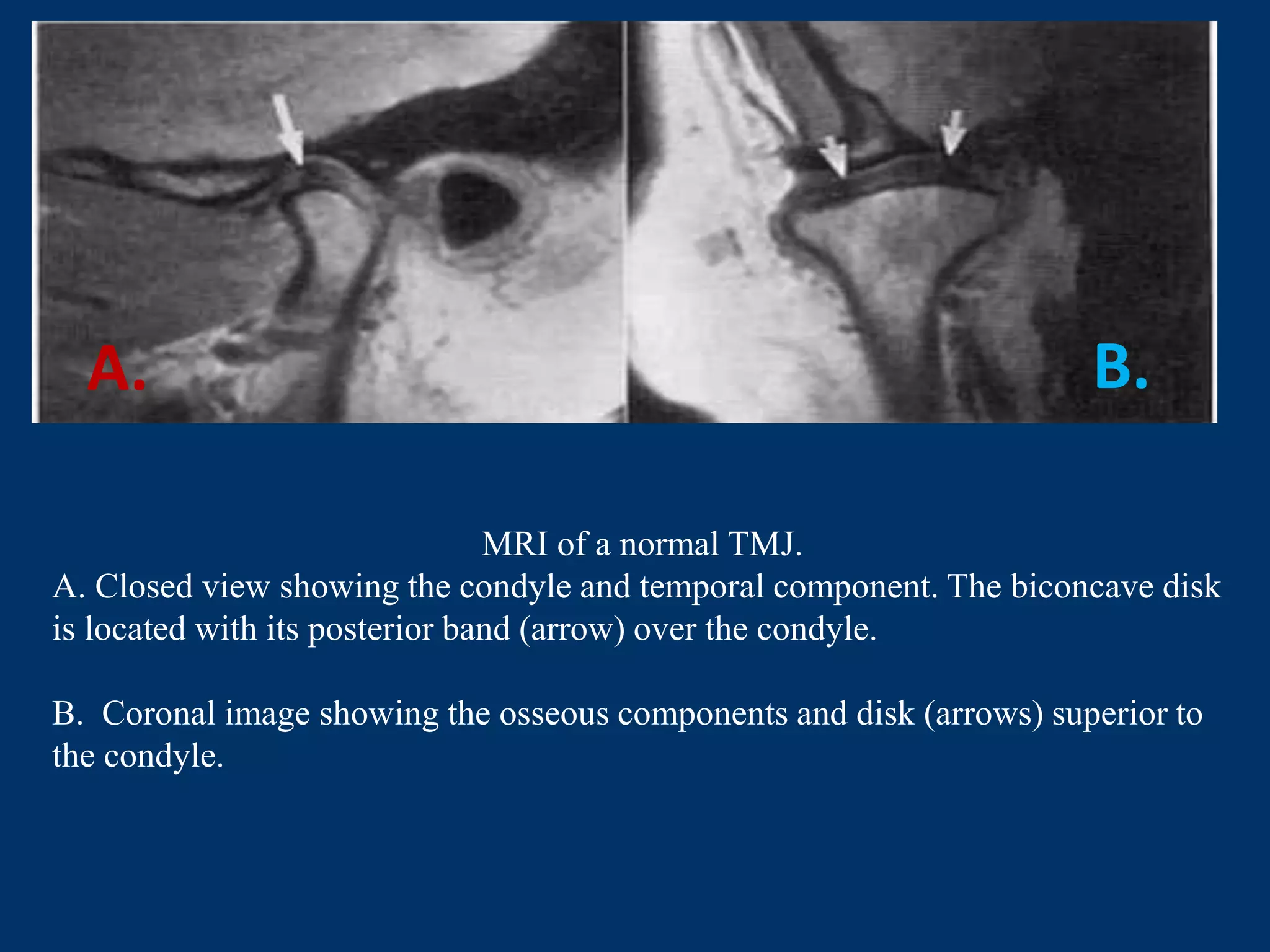 Temporomandibular joint imaging | PPTX