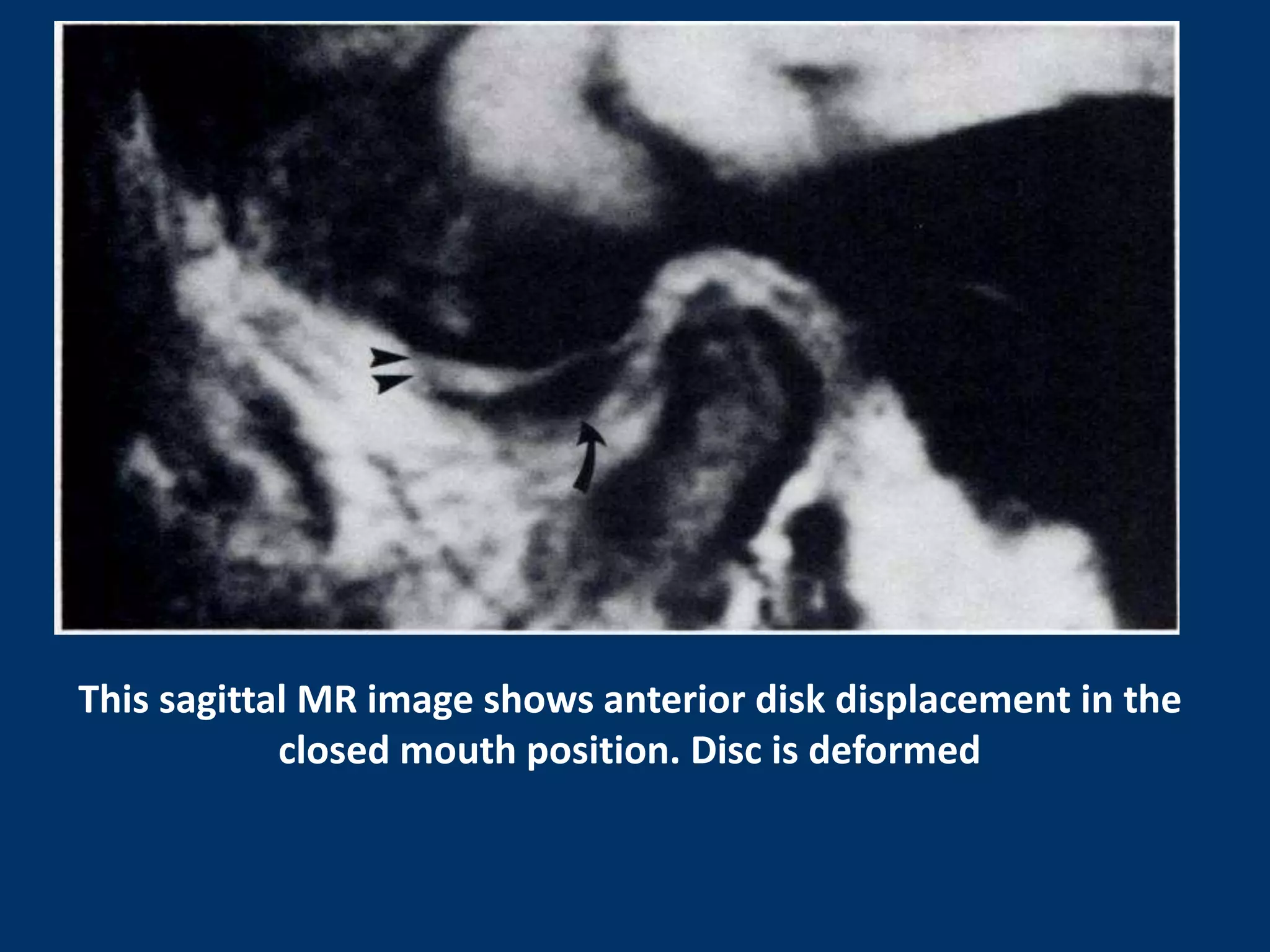 Temporomandibular joint imaging | PPTX