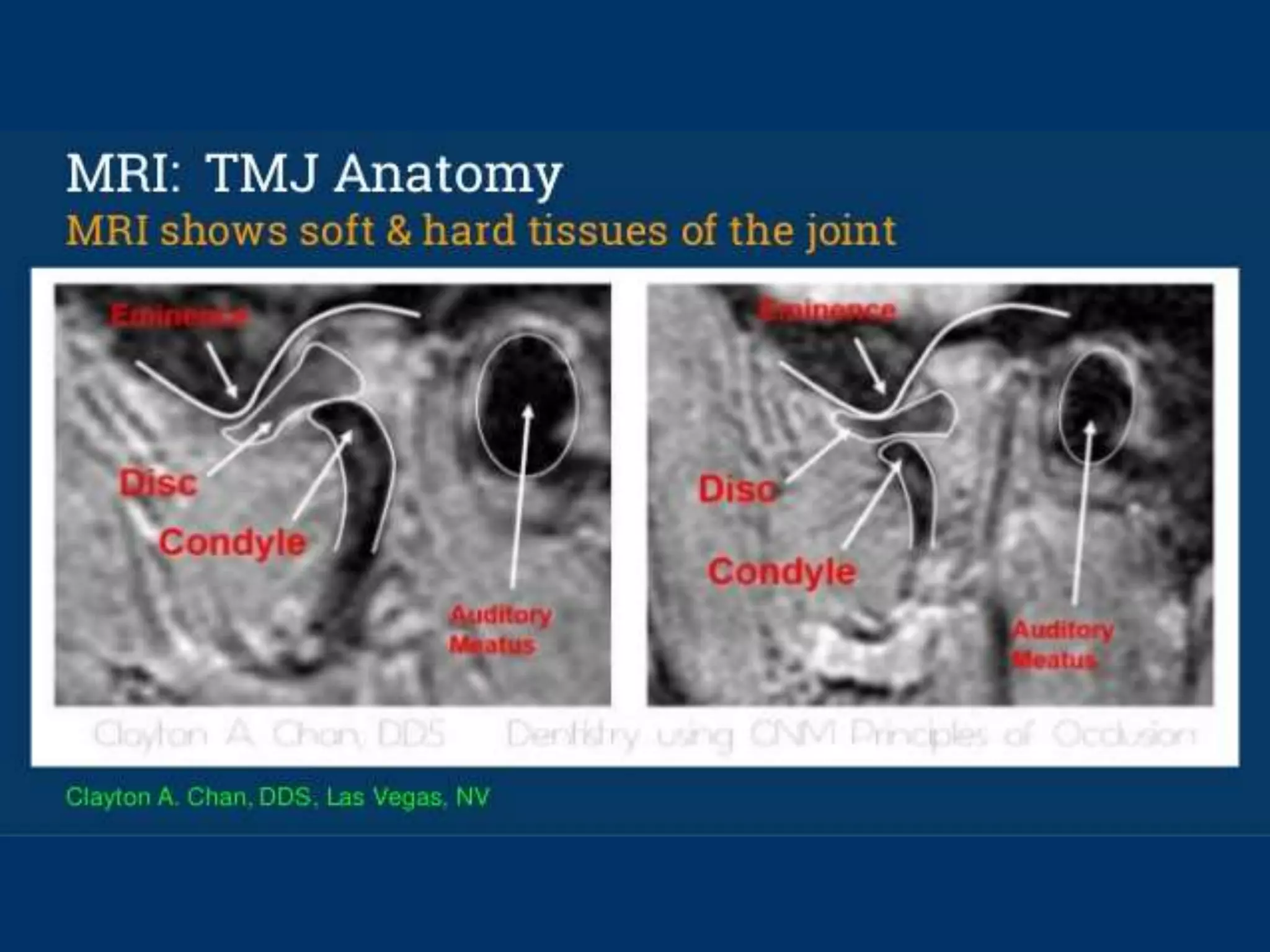 Temporomandibular joint imaging | PPTX