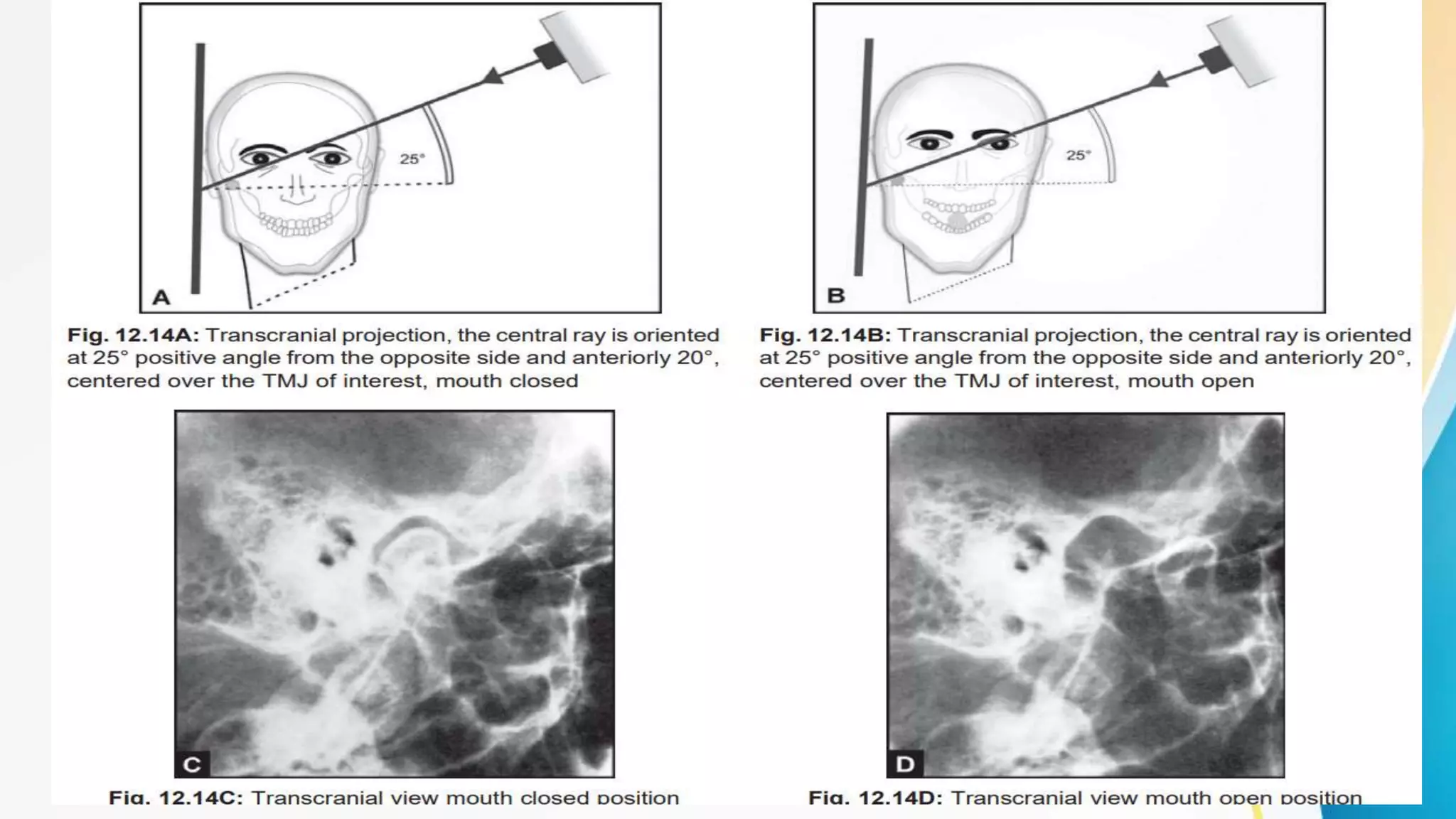 Temporomandibular joint imaging part-1 | PPTX