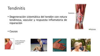 Tendinitis | PDF