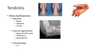 Tendinitis | PDF