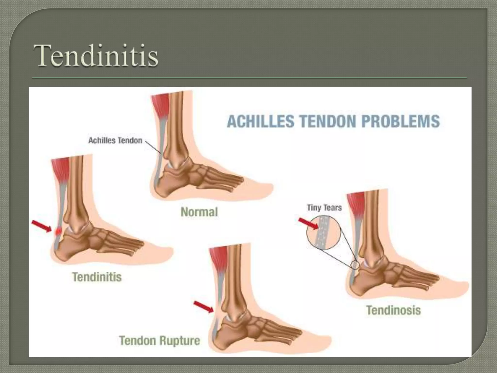 Tendinitis effective treatment of an overuse injury | PPTX