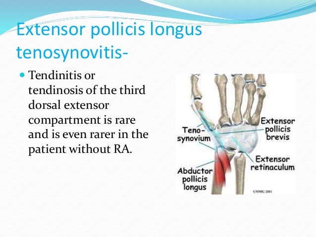Tendinopathies of wrist and hand