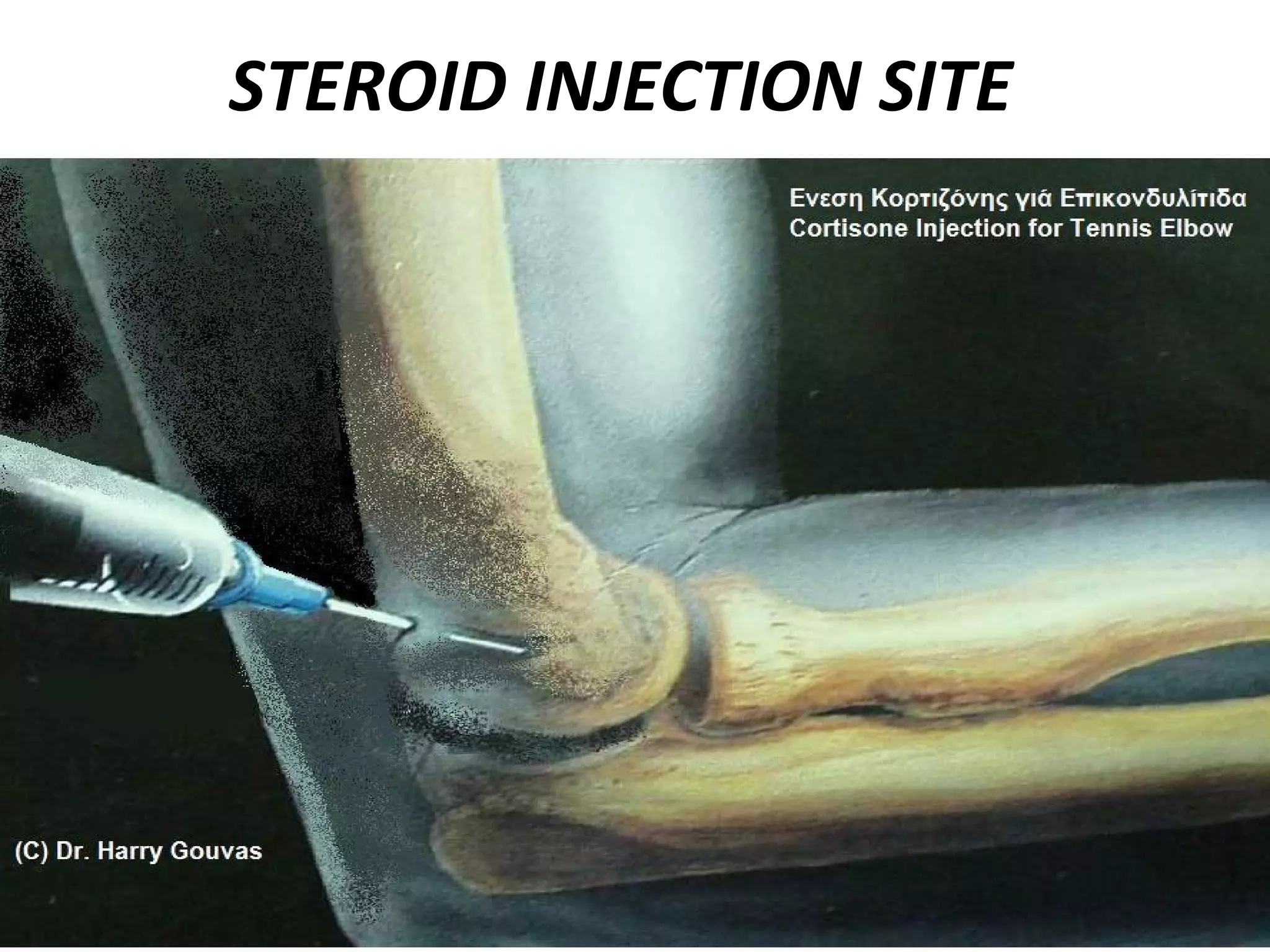 Tendinopathies(tennis,golfers,dequervains,intersection syndrome) | PPT
