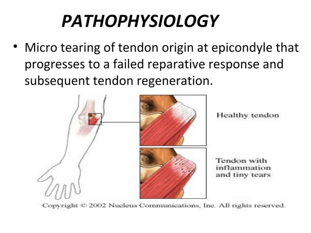 Tendinopathies(tennis,golfers,dequervains,intersection syndrome) | PPT