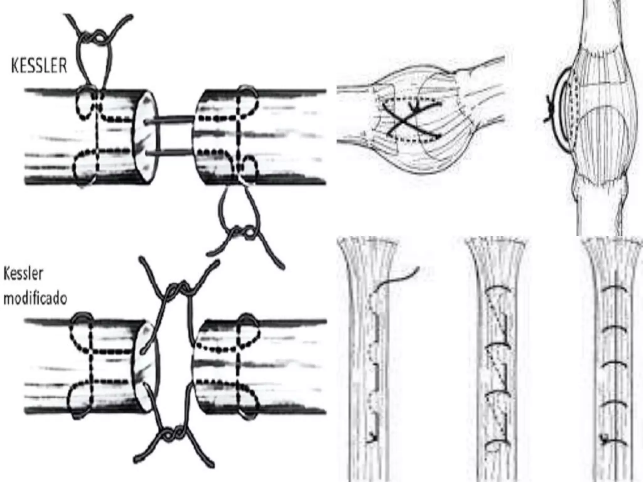 TENDINOPATHY AND TENDON REPAIR..pptx