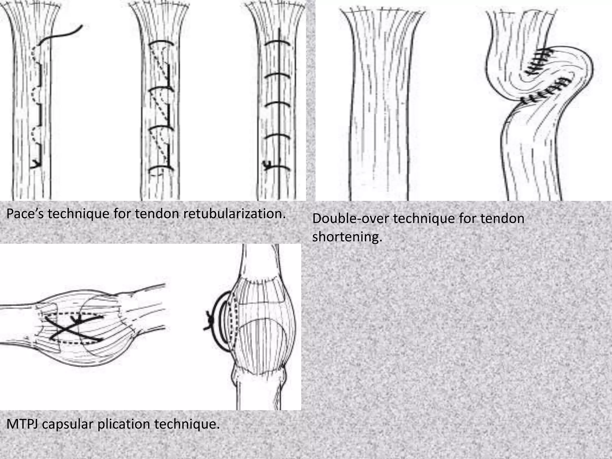 TENDINOPATHY AND TENDON REPAIR..pptx