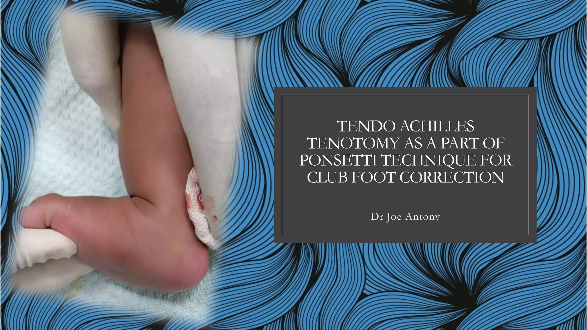 Tendo Achilles tenotomy as a part of Ponsetti technique | PPTX