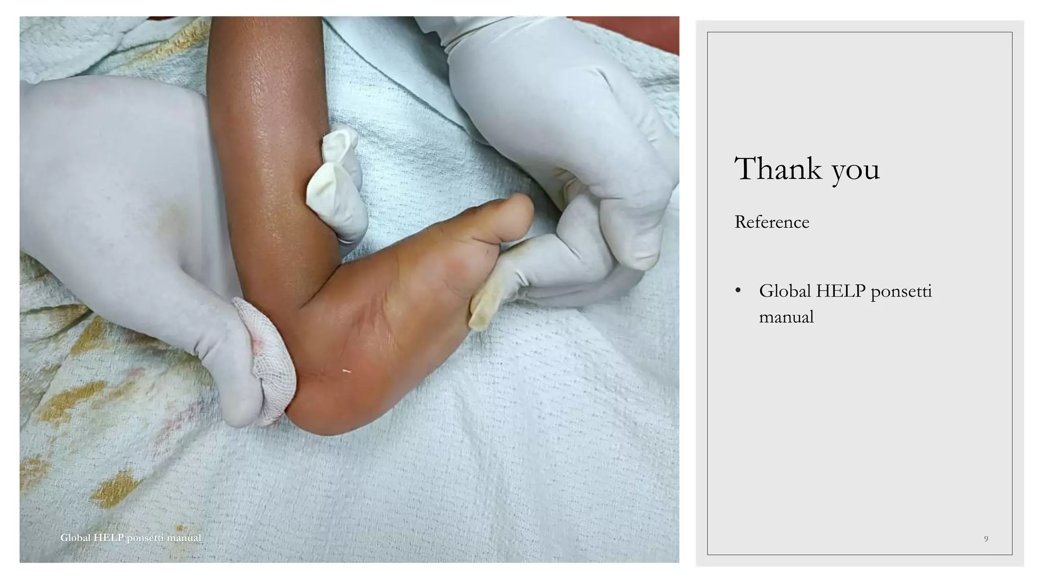 Tendo Achilles tenotomy as a part of Ponsetti technique | PPTX