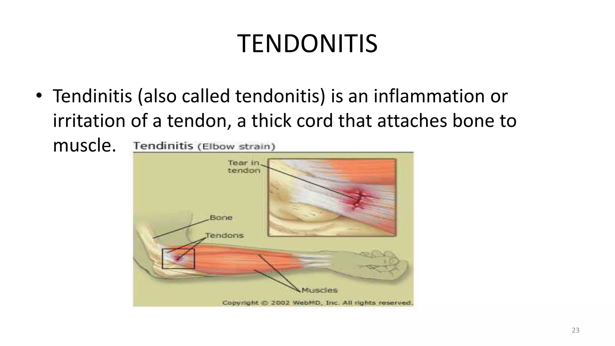 Tendon and ligament injureies | PPTX