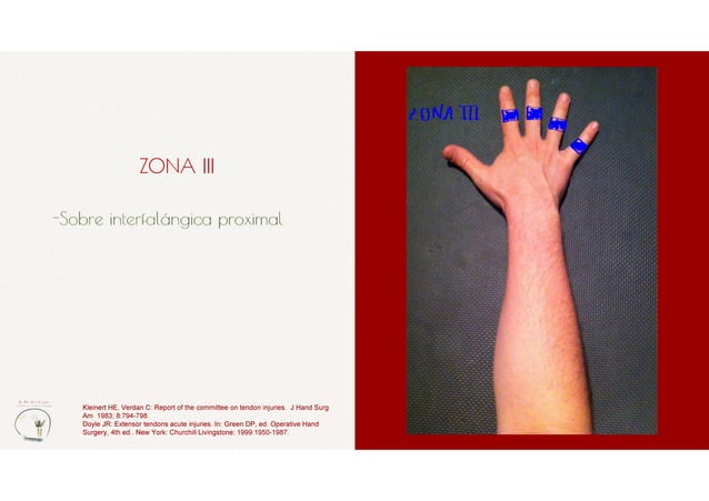 Lesiones de los Tendones Extensores de la Mano - Dr. Alex Ortiz Espada ...