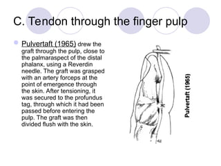 flexor TENDON GRAFTING one and two stage.ppt