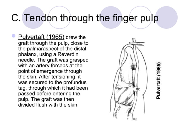flexor TENDON GRAFTING one and two stage.ppt