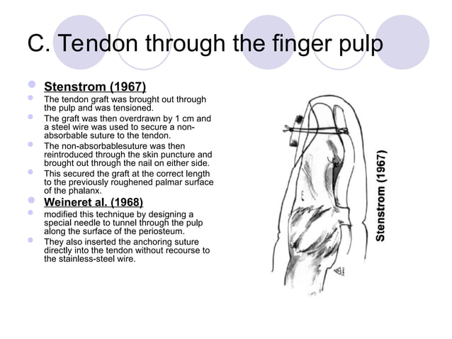 flexor TENDON GRAFTING one and two stage.ppt