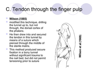 flexor TENDON GRAFTING one and two stage.ppt