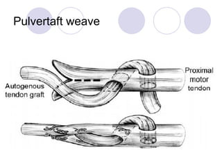 flexor TENDON GRAFTING one and two stage.ppt