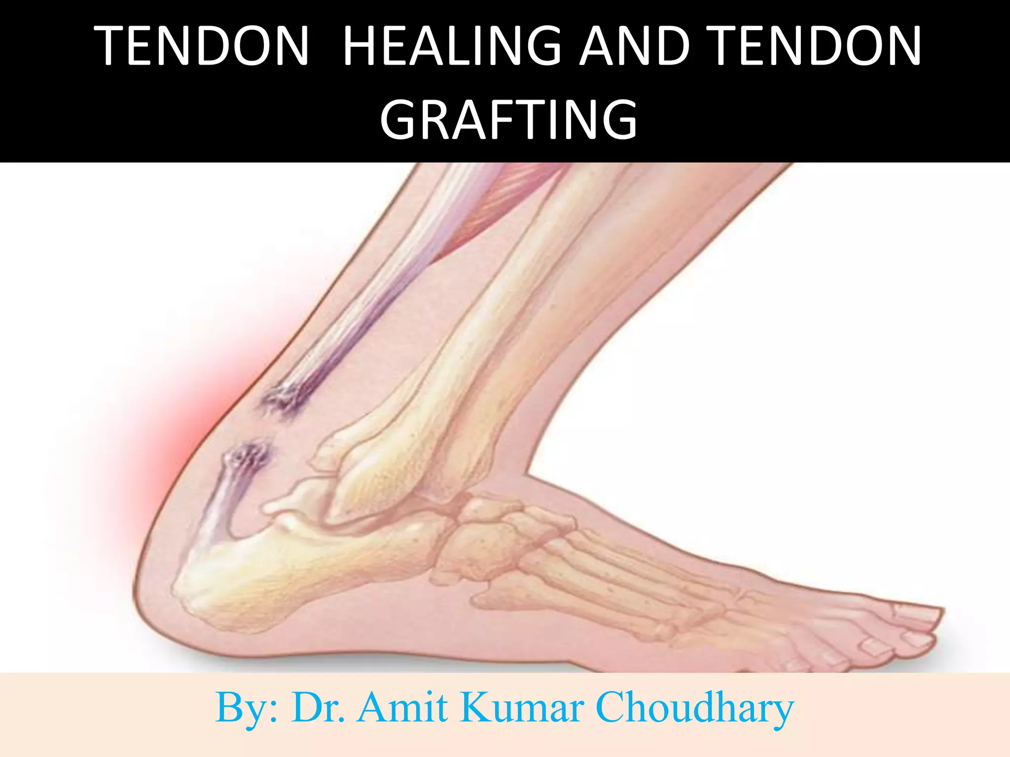 Tendon healing and tendon grafting | PPTX