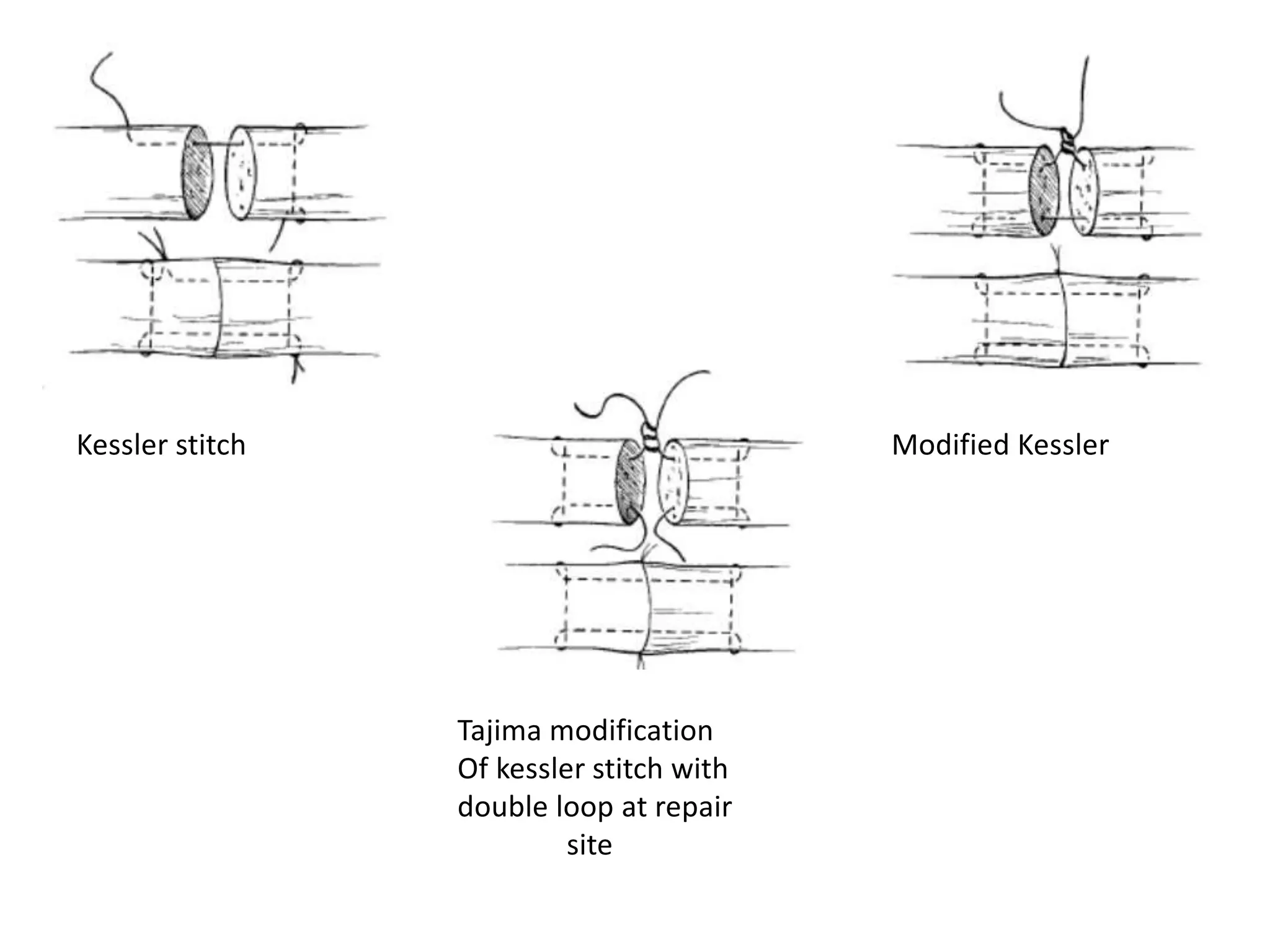 Tendon injuries of hand | PPTX