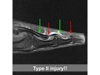 Tendon injuries of hand | PPTX