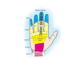 Tendon injuries of hand | PPTX