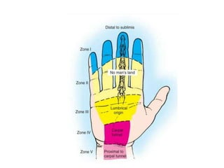 Tendon injuries of hand | PPTX