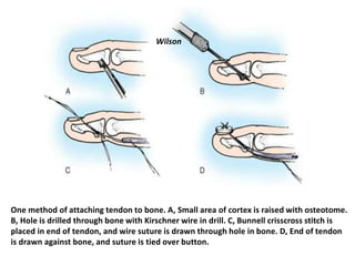 Tendon injuries of hand | PPTX