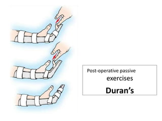 Tendon injuries of hand | PPTX