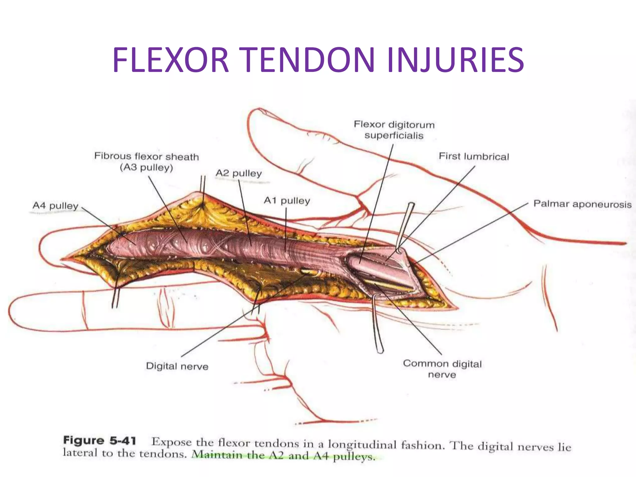 Tendon injuries of hand by Dr Saumya Agarwal | PPTX