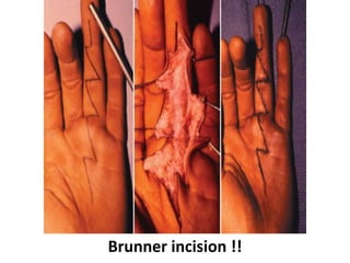 Tendon injuries of hand by Dr Saumya Agarwal | PPTX