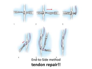 Tendon injuries of hand by Dr Saumya Agarwal | PPTX