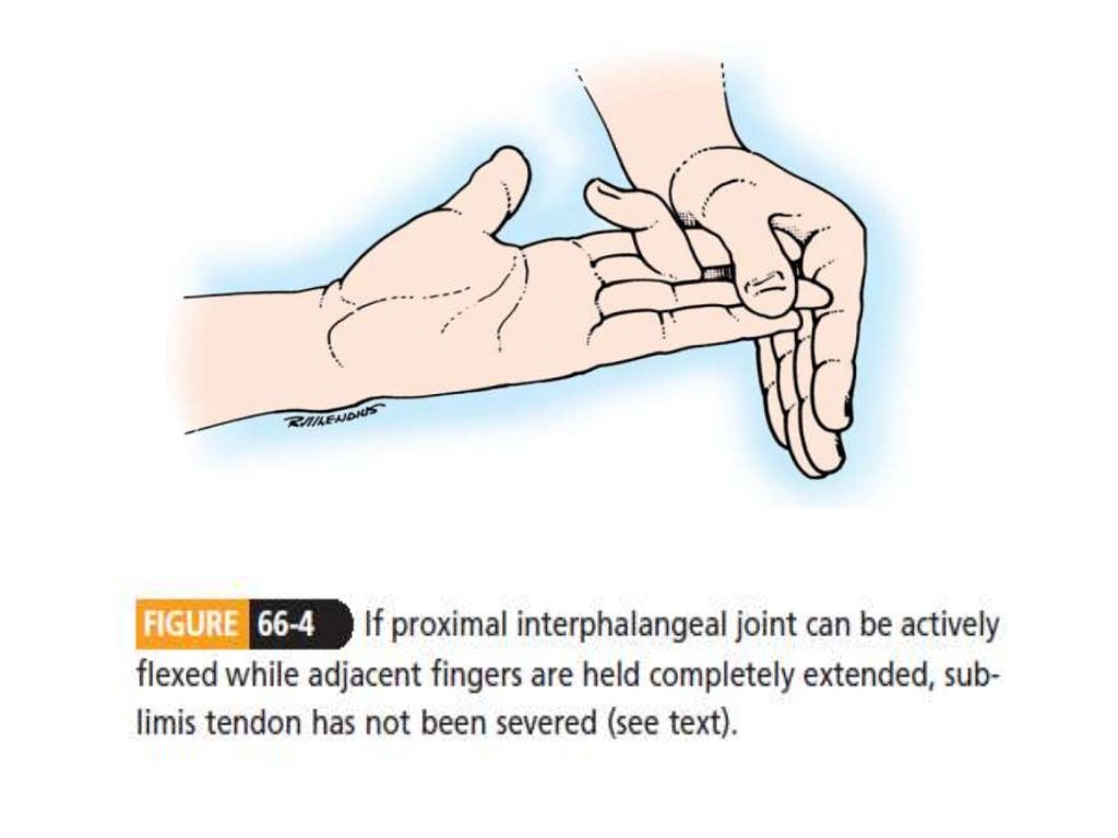 Tendon injuries of hand by Dr Saumya Agarwal