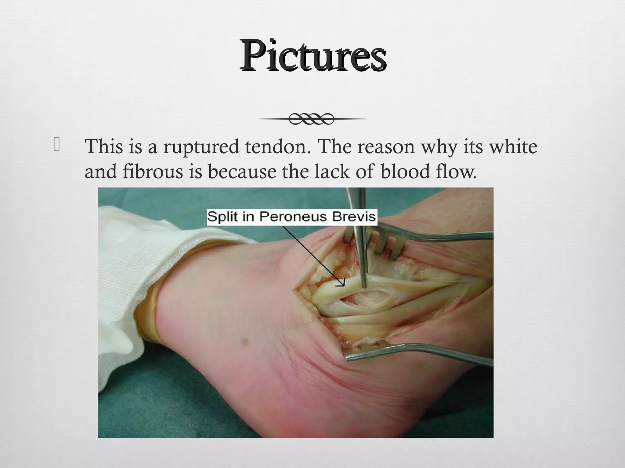 Ankle Tendonitis | PPT