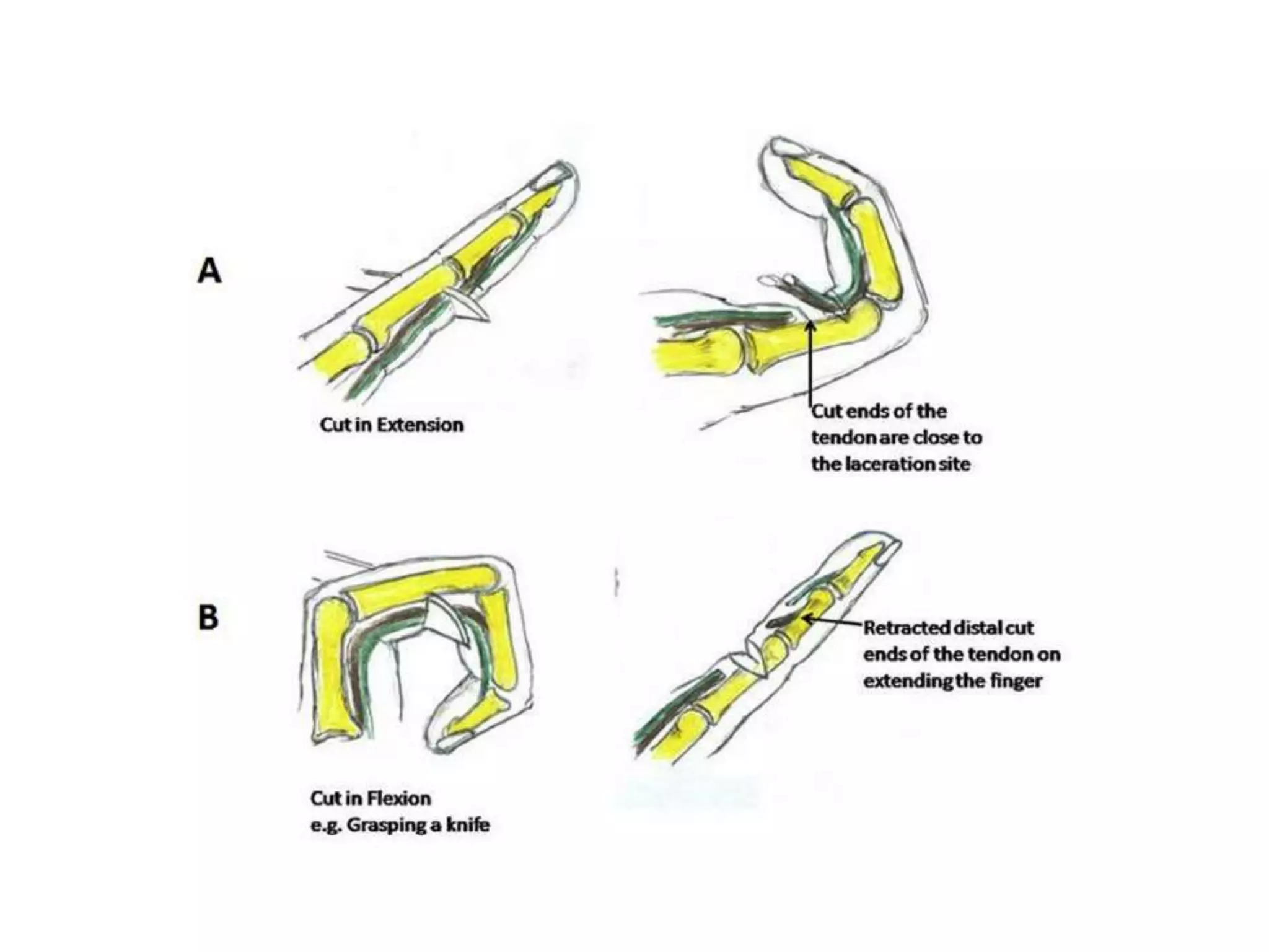 Tendon reconstruction | PPTX