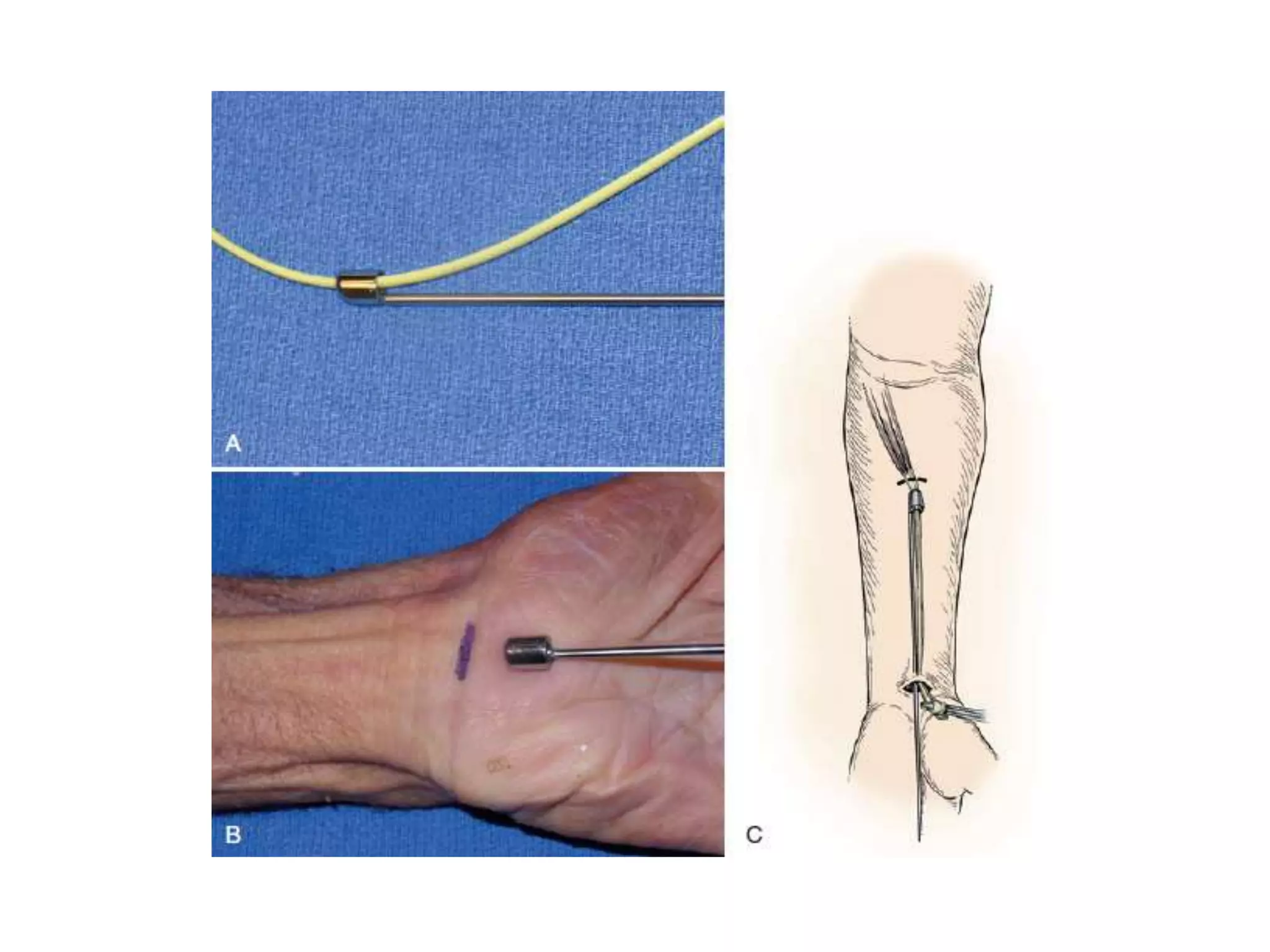Tendon reconstruction | PPTX