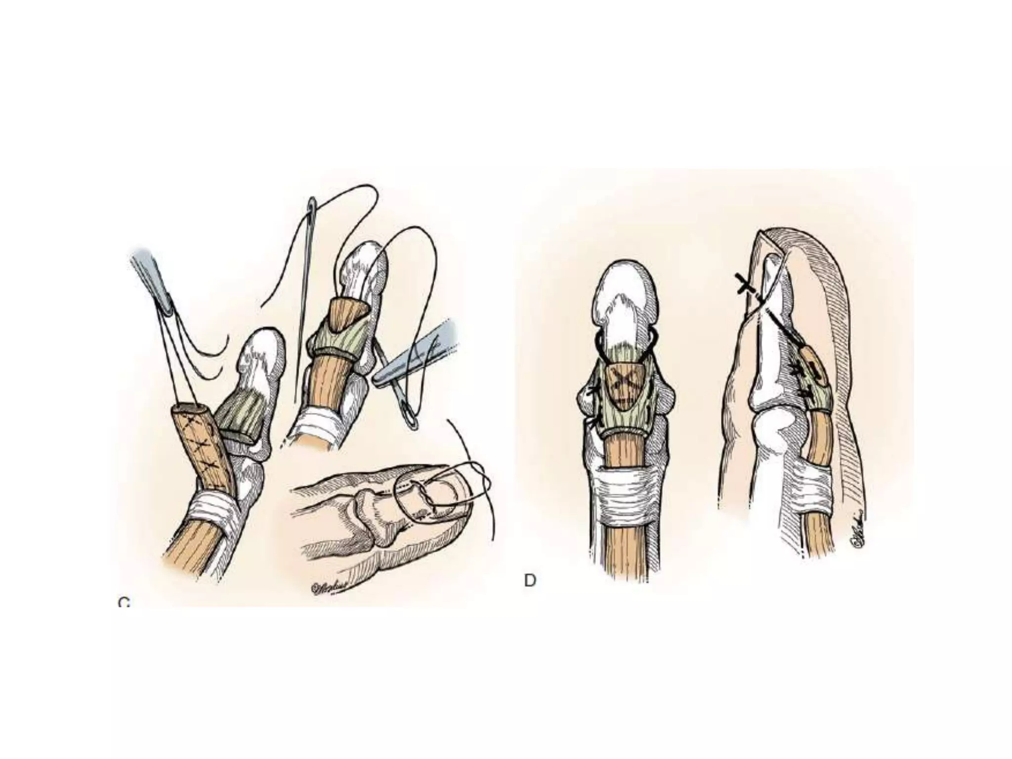 Tendon reconstruction | PPTX