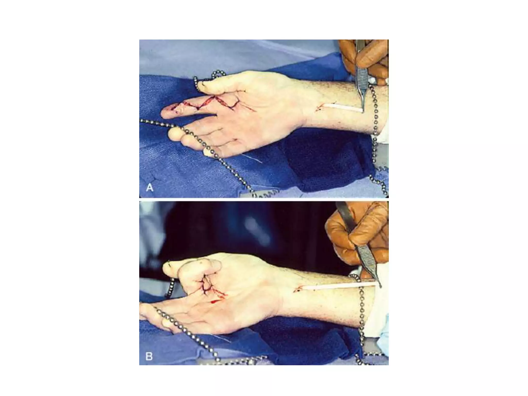 Tendon reconstruction | PPTX