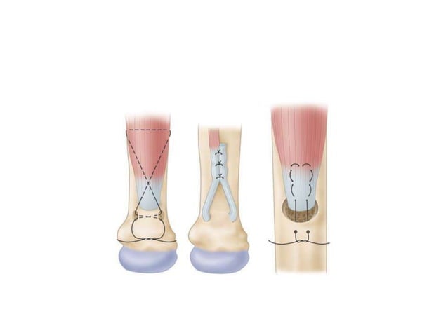 Tendon repair | PPTX