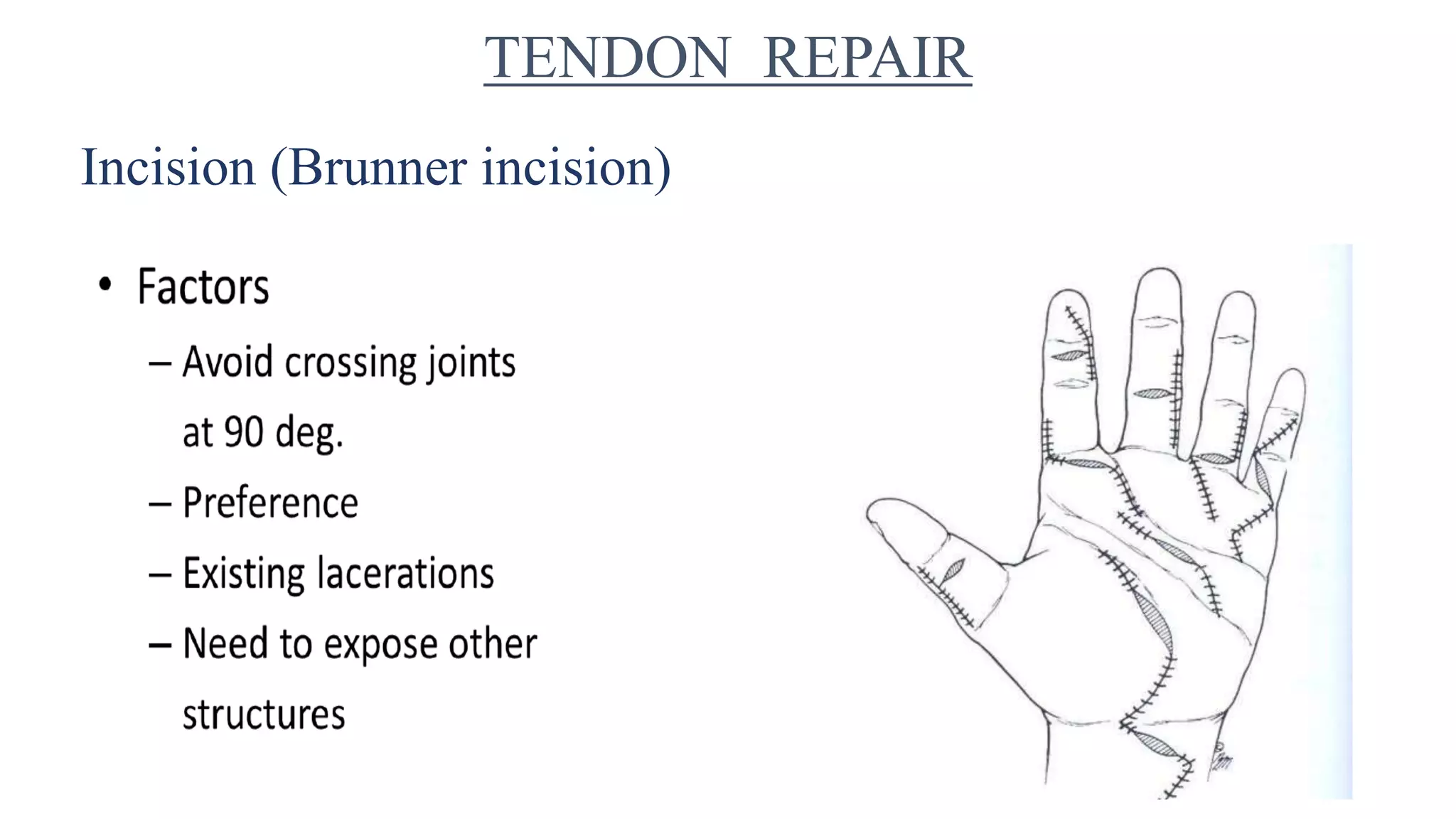 Tendon repair | PPTX