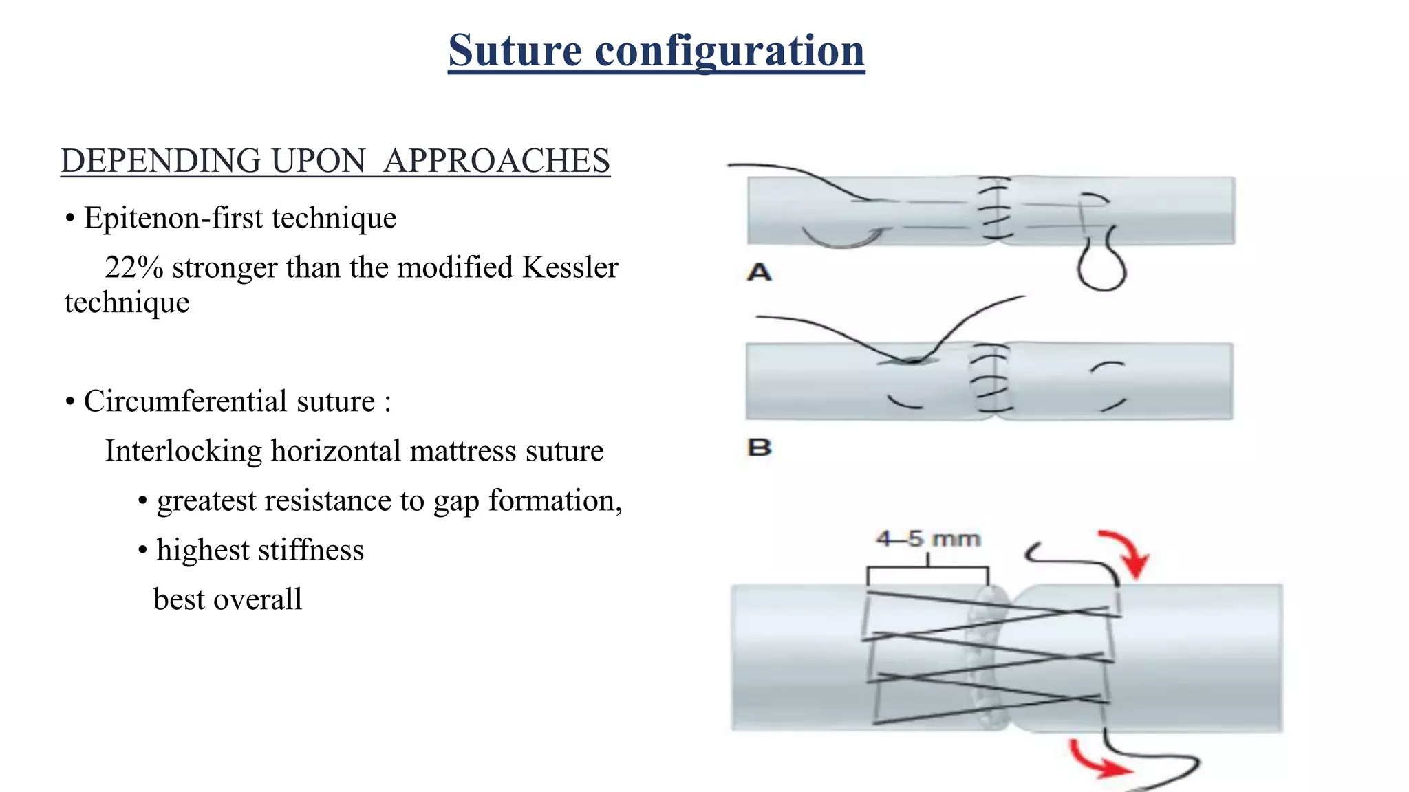 Tendon repair | PPTX