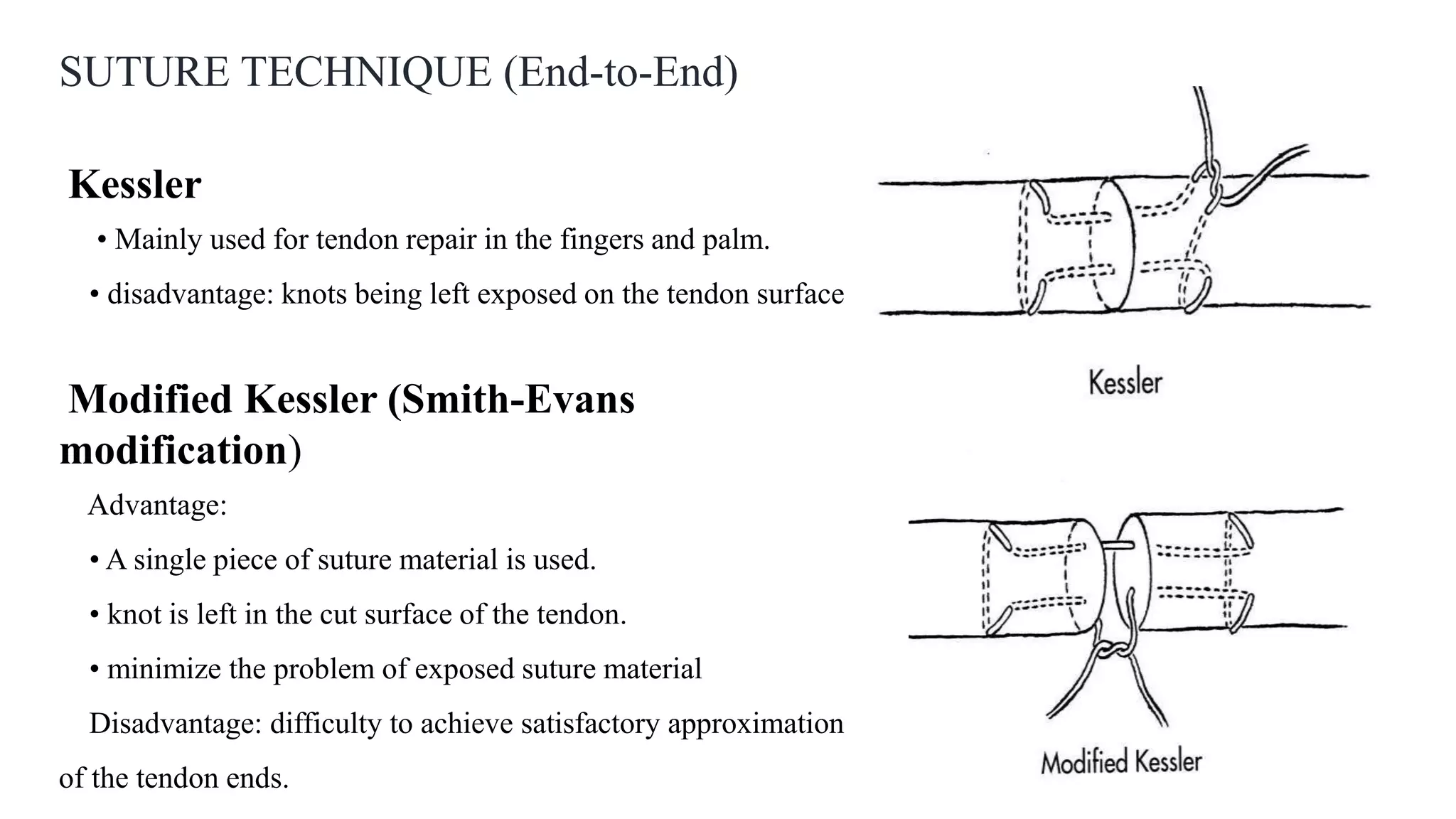 Tendon repair | PPTX