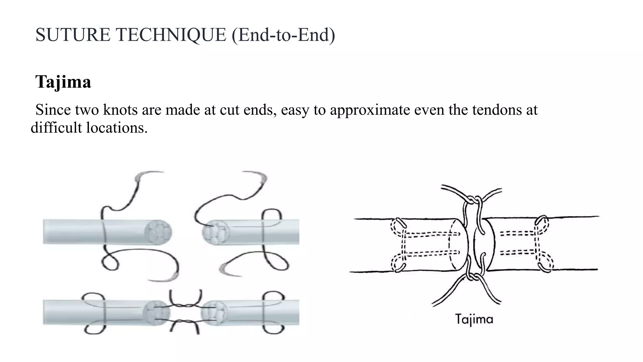 Tendon repair | PPTX