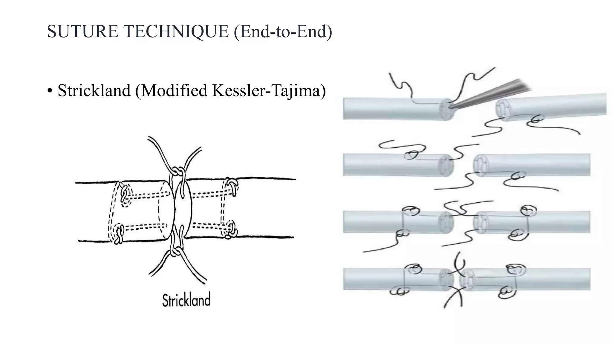 Tendon repair | PPTX