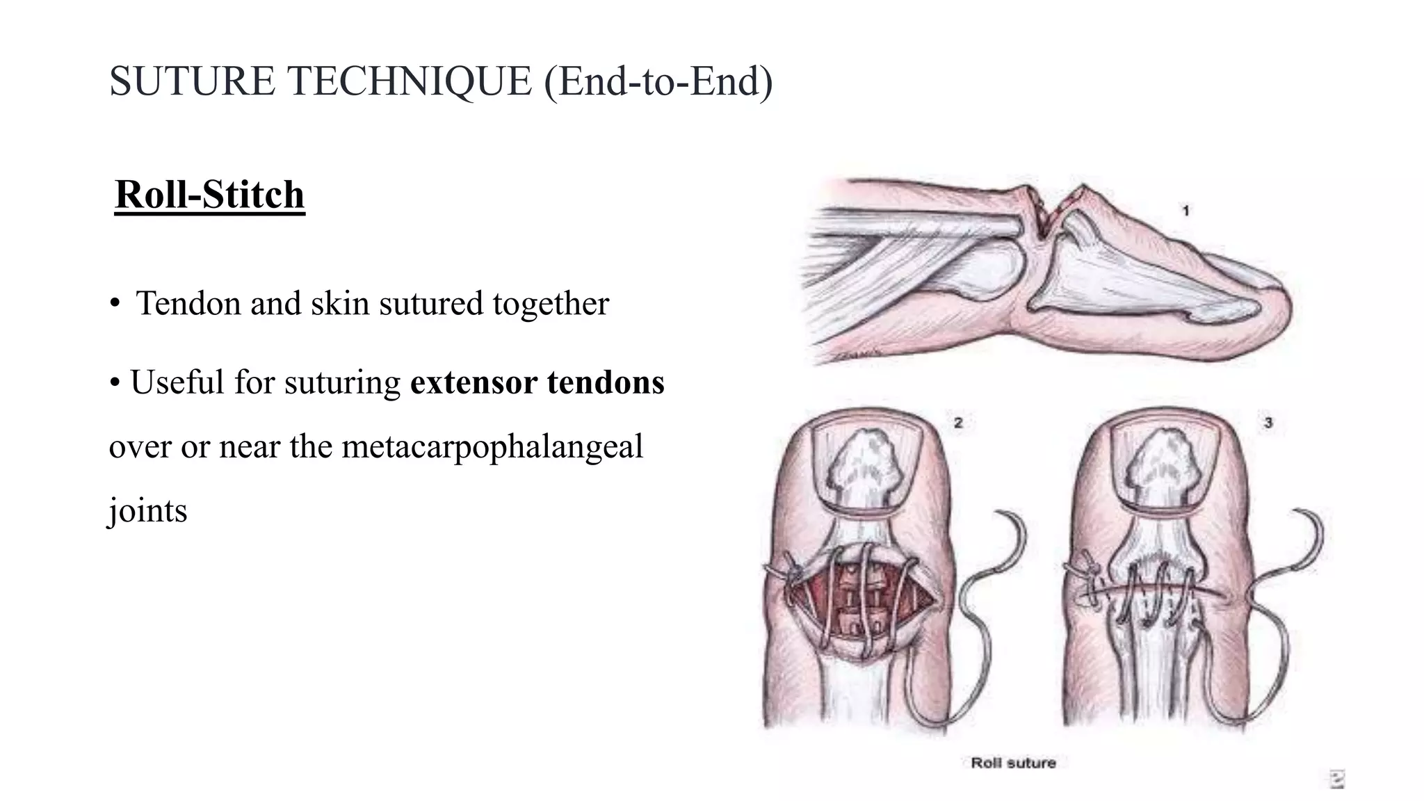 Tendon repair | PPTX