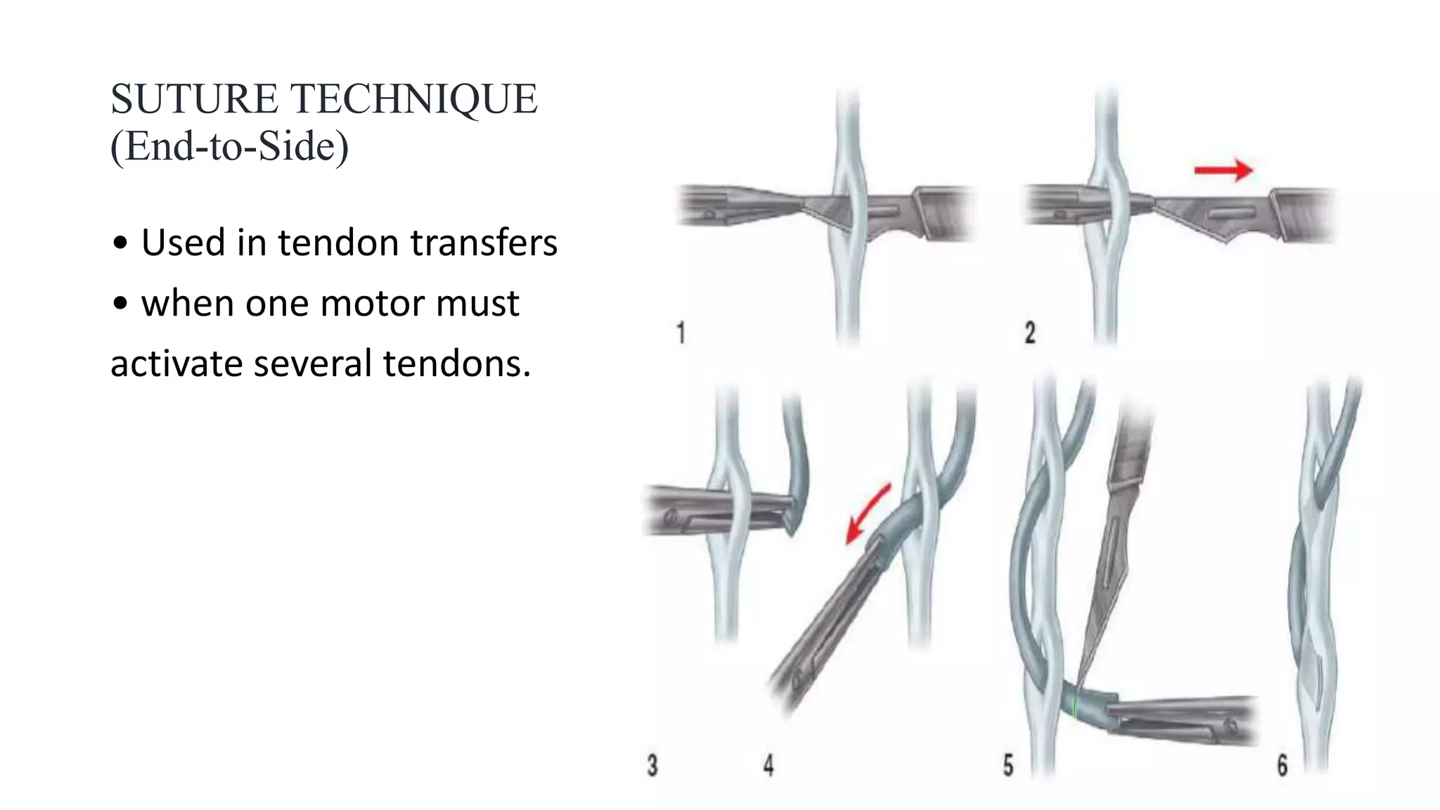 Tendon repair | PPTX