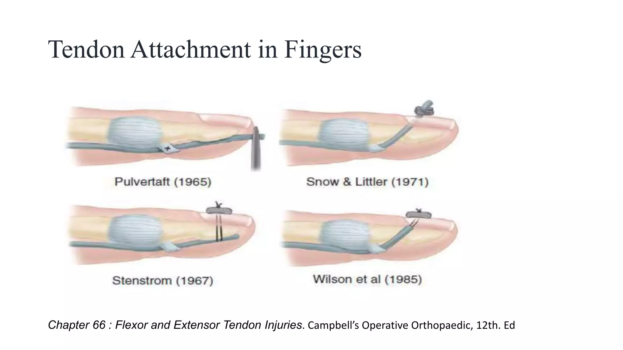Tendon repair | PPTX
