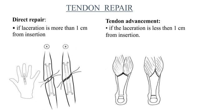 Tendon repair | PPTX | Death, Injury, or Military Conflict | Sensitive ...
