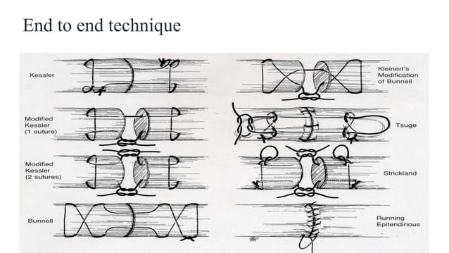 Tendon repair | PPTX | Death, Injury, or Military Conflict | Sensitive ...