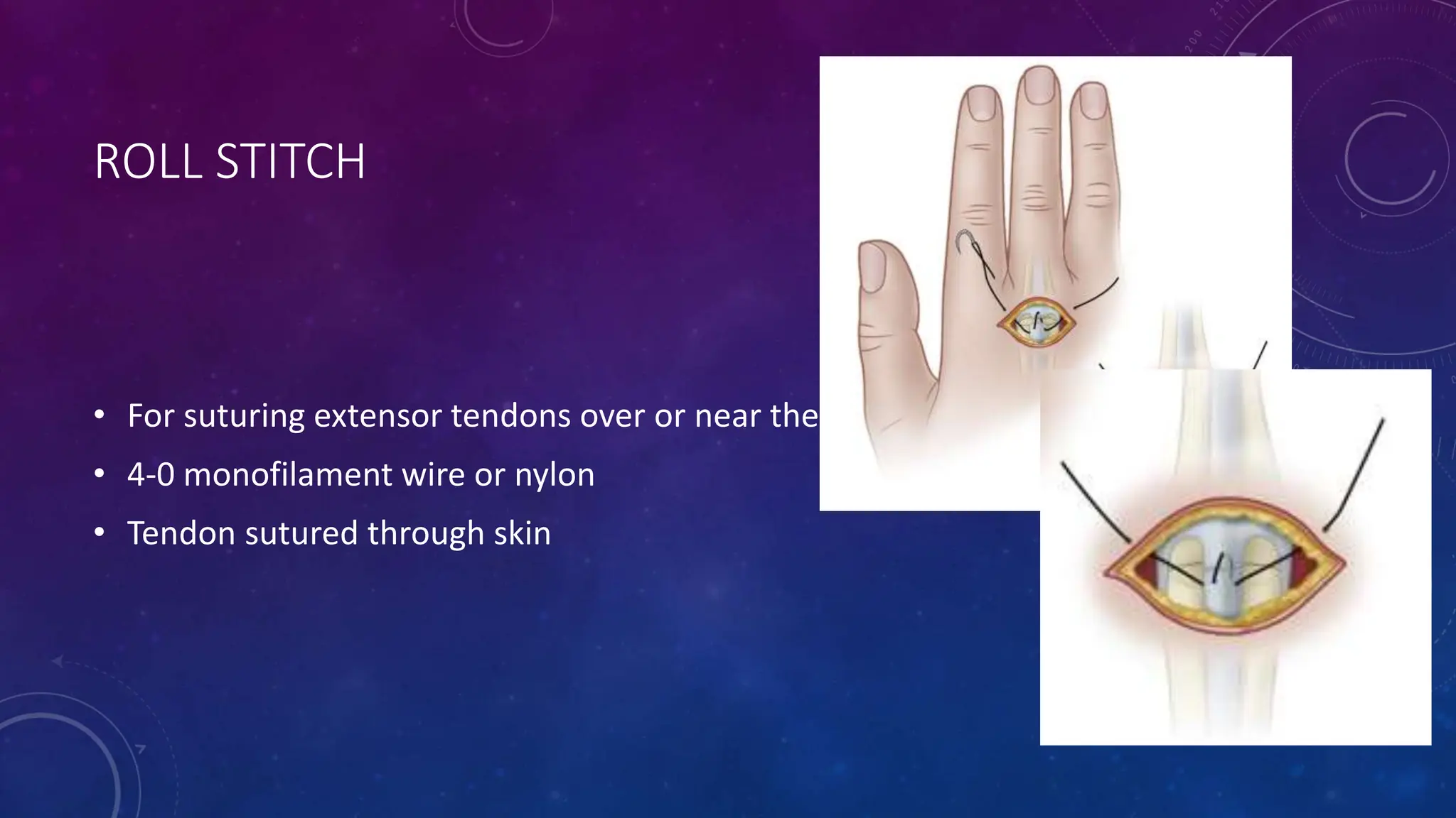 TENDON REPAIR – PRINCIPLES ^0 TYPES-1.pptx